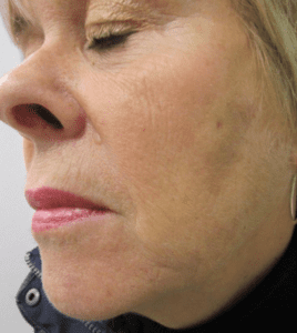 Facial Sagging Treatment in Bexhill, East Sussex